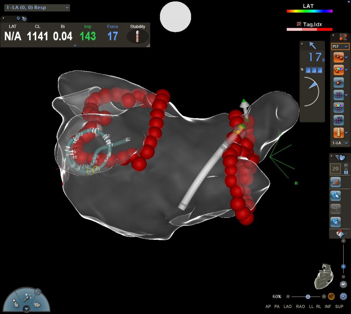 Ablationstherapie – Dr. Martinek